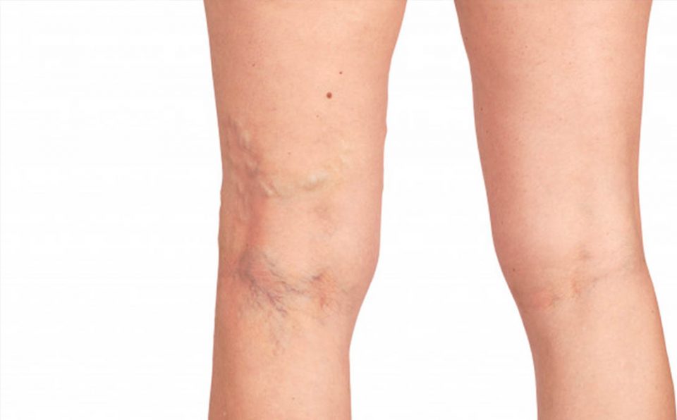 Fleboesclerosis con espuma archivos - Hospital Nuestra Señora del Rosario